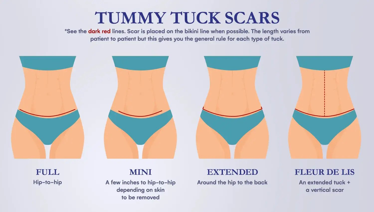 The Different Types Of Tummy Tucks Available In Nj Ny And Pa 8971
